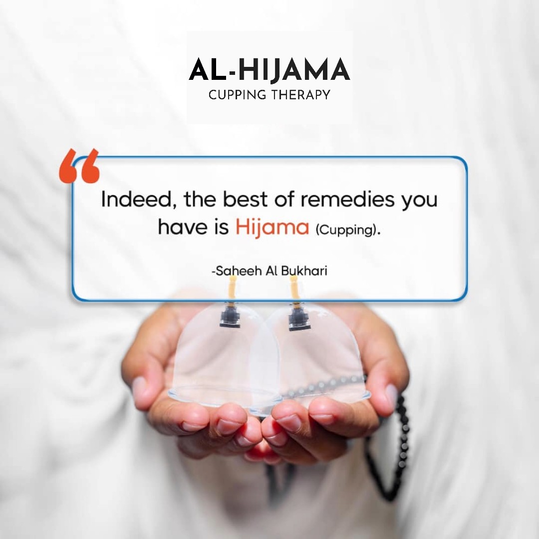 🌿 Benefits of Hijama Cupping 🌿